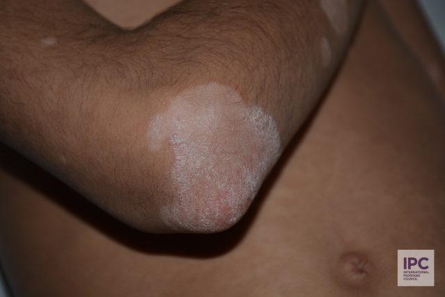 Diverse Skin Images - New Filter Gallery | International Psoriasis Council