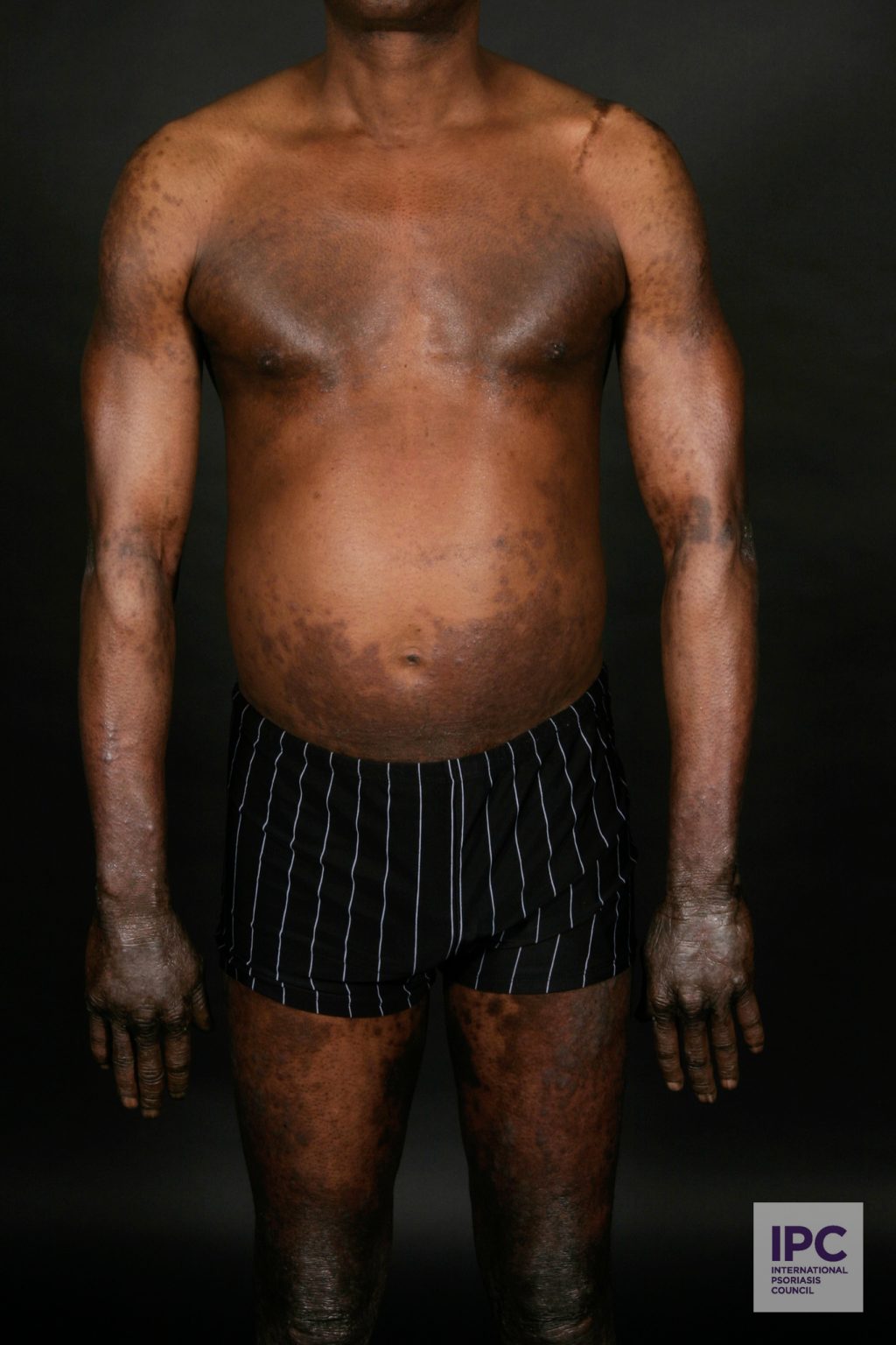 Diverse Skin Images - New Filter Gallery | International Psoriasis Council