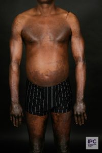 Diverse Skin Images - New Filter Gallery | International Psoriasis Council